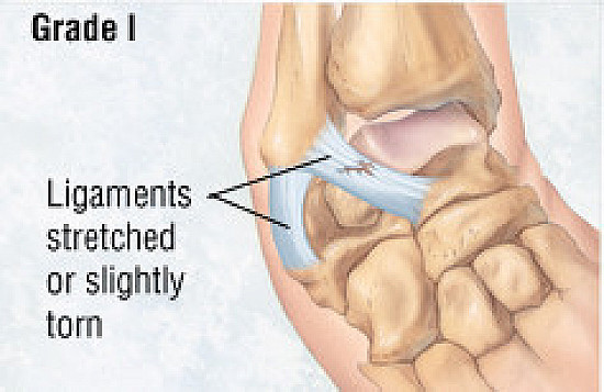 Sprain (Overview) - Harvard Health