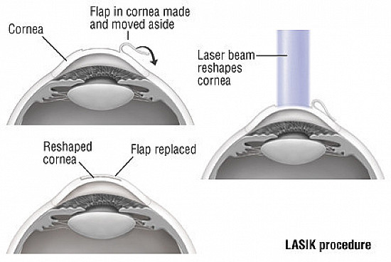 LASIK - Harvard Health