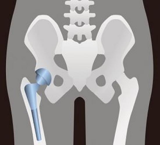 Total Hip Replacement - Harvard Health