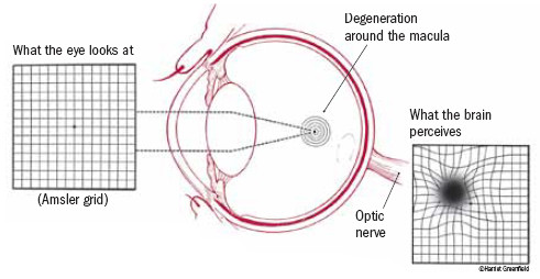 AMD: a preventable form of vision loss - Harvard Health