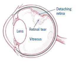 Specks in your vision can signal serious eye conditions - Harvard Health