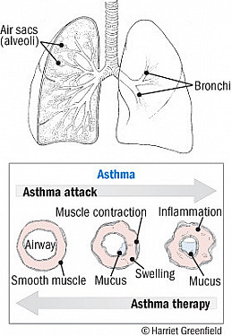 Asthma - Harvard Health