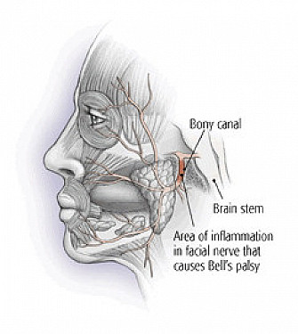 Bell's Palsy - Harvard Health