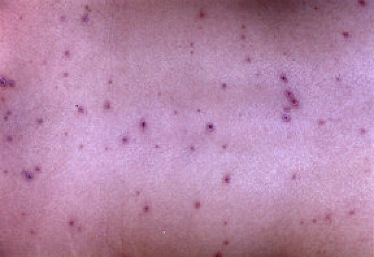 Chickenpox (Varicella) - Harvard Health