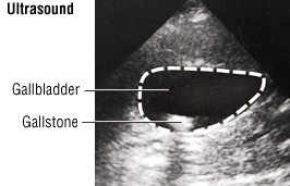 Gallstones - Harvard Health
