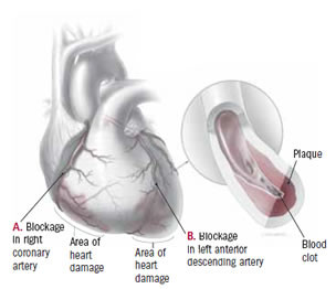Heart Attack (Myocardial Infarction) - Harvard Health