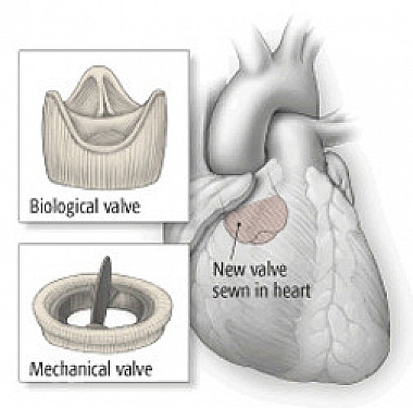 Heart Valve Problems - Harvard Health