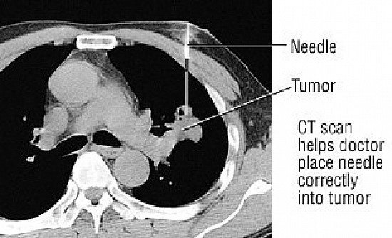Lung Cancer Overview - Harvard Health