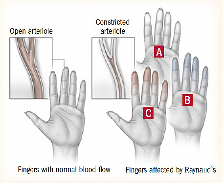 Raynaud's Phenomenon - Harvard Health