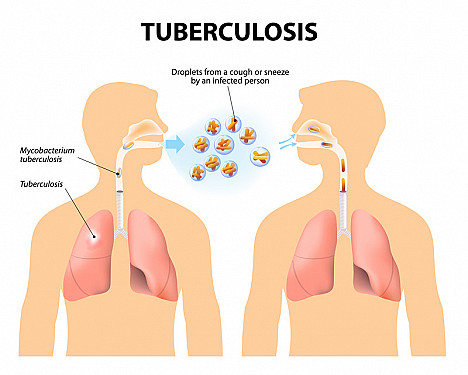 Tuberculosis - Harvard Health
