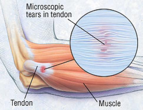 Tendonitis - Harvard Health