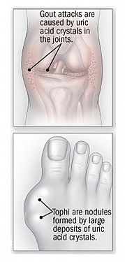 Gout - Harvard Health