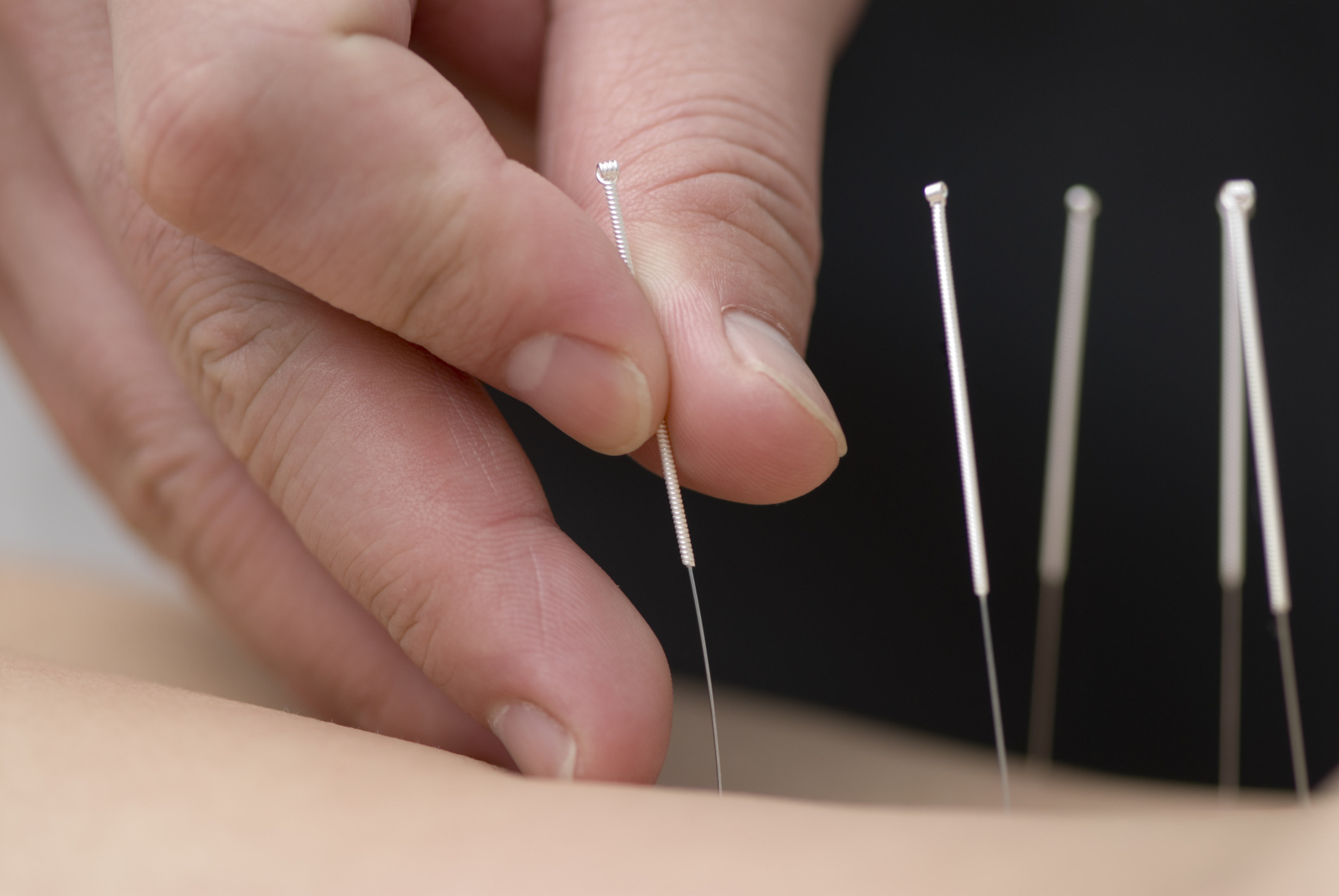 Acupuncture A Point In The Right Direction Or A Stab In The Dark
